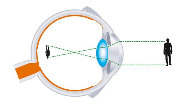 Informatie oogziekten | cataract | refractie afwijkingen | Oogmeting